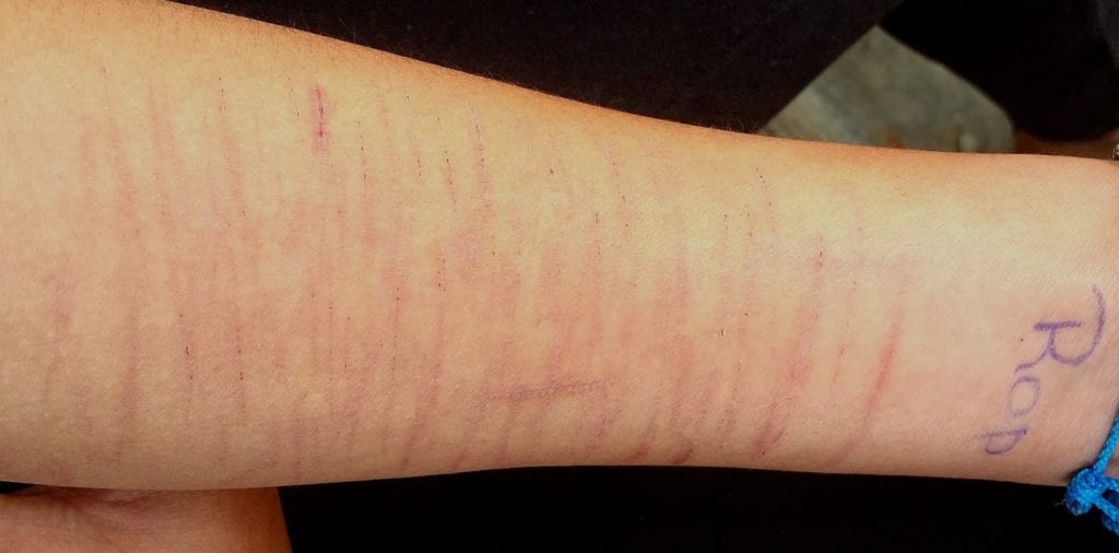 Scars on Daniela | Catholic MissionariesFamily Missions Company